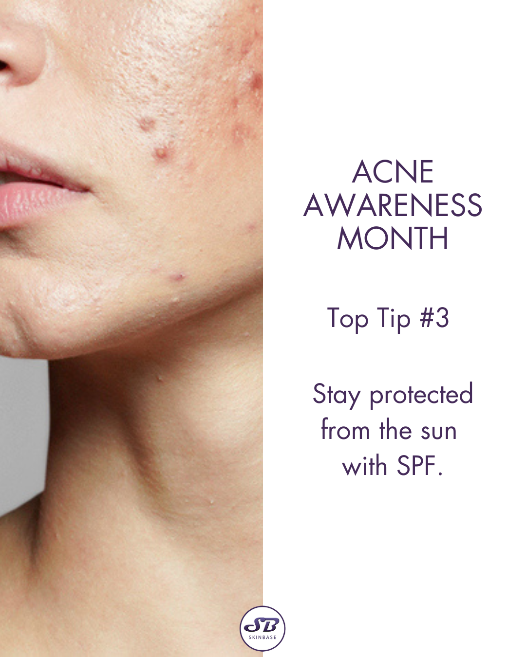 Acne Awareness Month - Microdermabrasion Grid Post Series