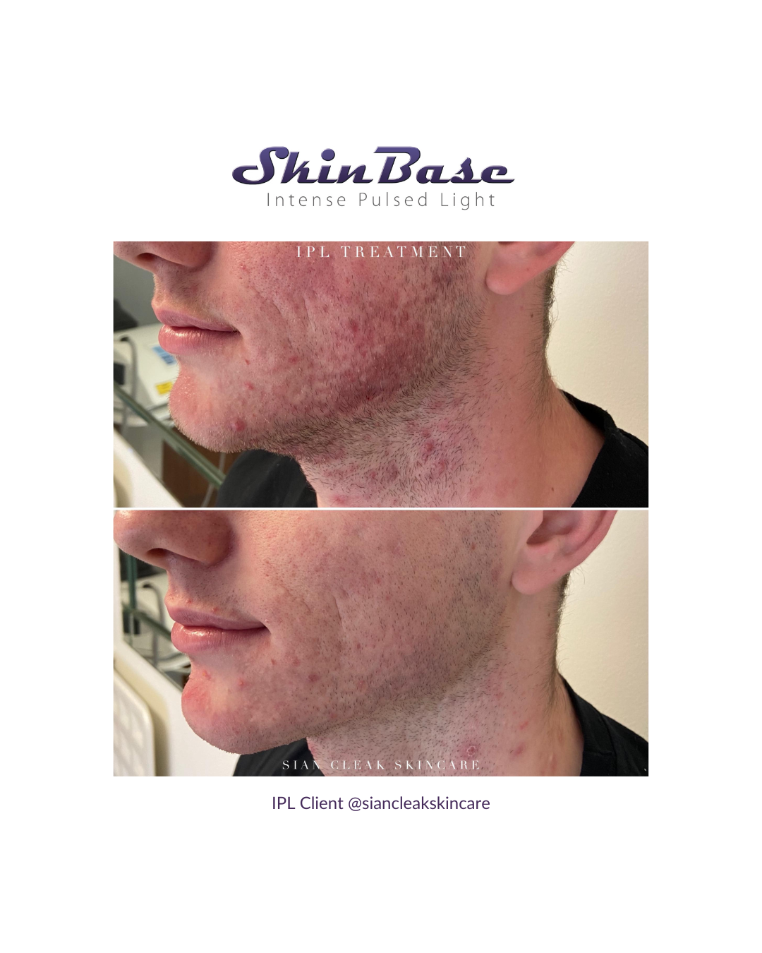 IPL Promotional Posts